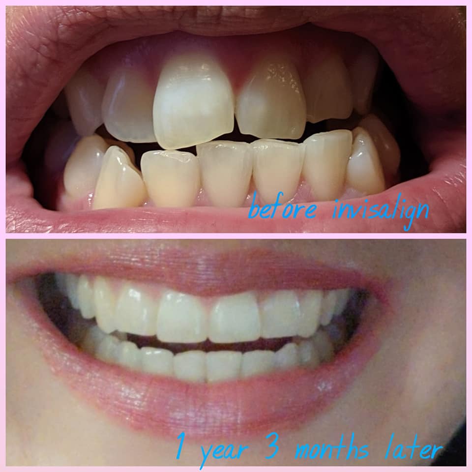 Invisalign London - Braces by UK's Top Orthodontist