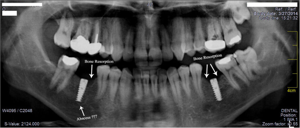 Bone Resorption: What causes bone resorption? Is it good or bad