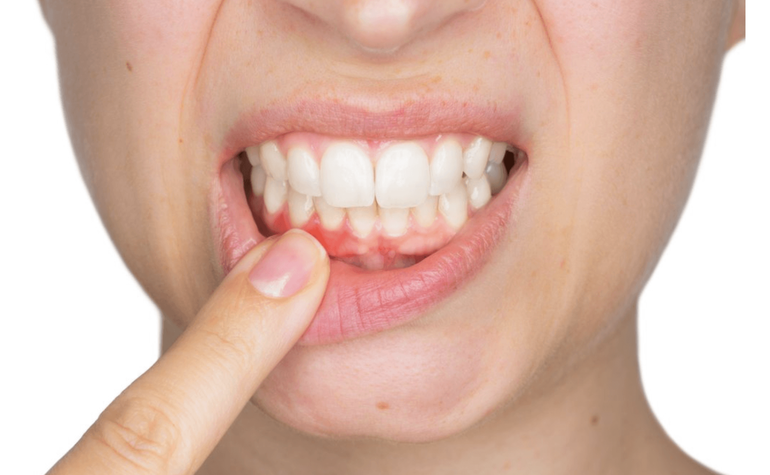 Gum Abscess Overview: Stages, Symptoms, Treatment