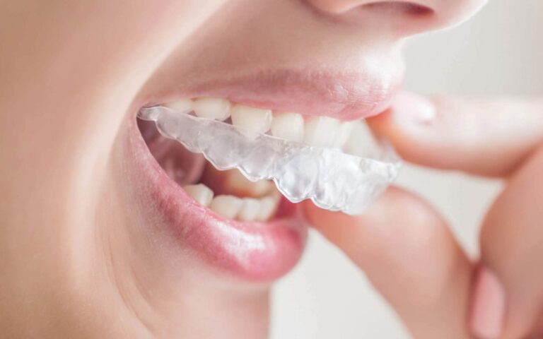 Can Invisalign Fix Overbite? - Guide to an Orthodontic Treatment ...