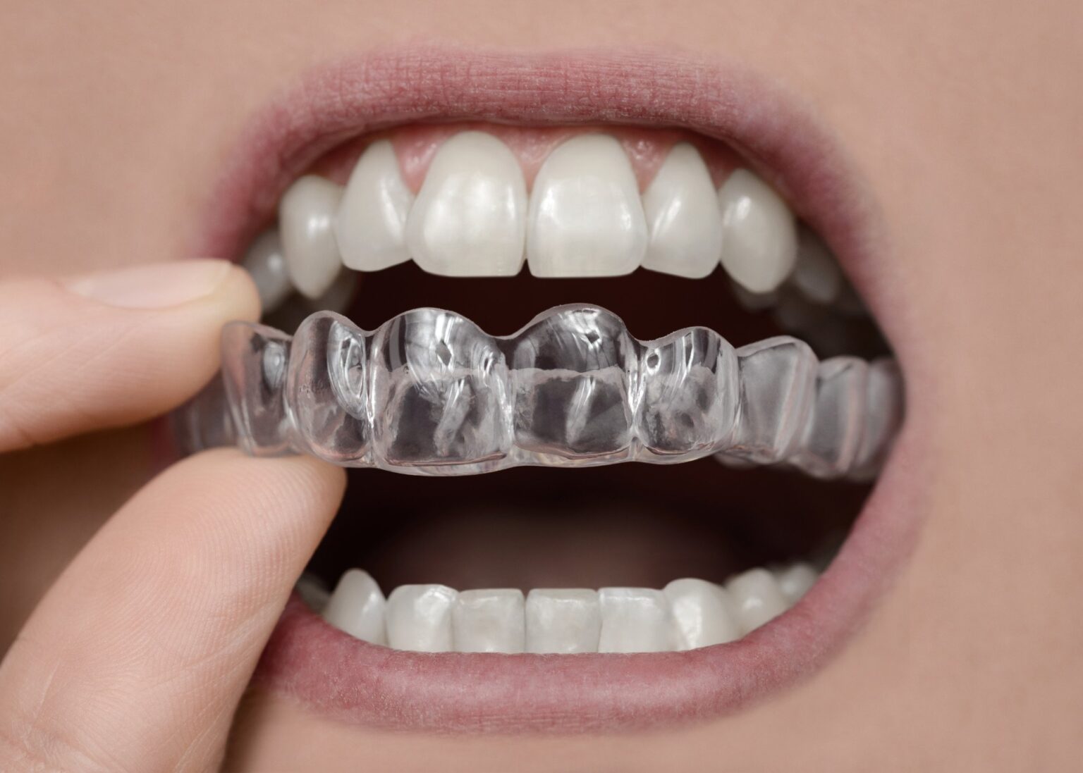 What are Replacement Retainers? - Invisalign London