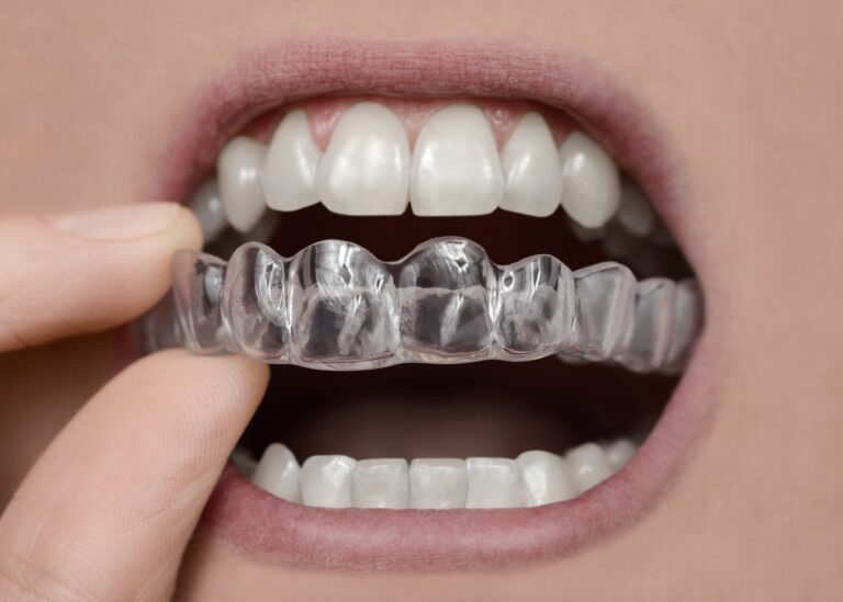 What are Replacement Retainers? - Invisalign London